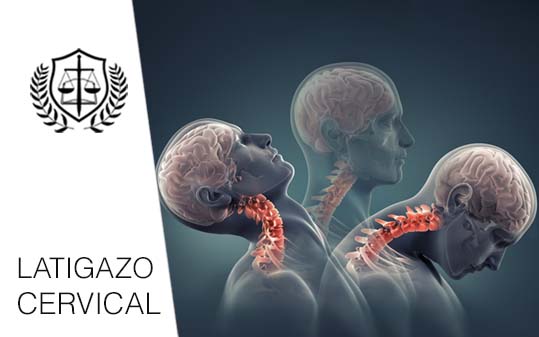 Claves de la máxima indemnización por Latigazo Cervical